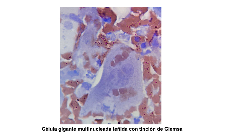 Herpes simple ulcerado en pacientes VIH – PIEL-L Latinoamericana