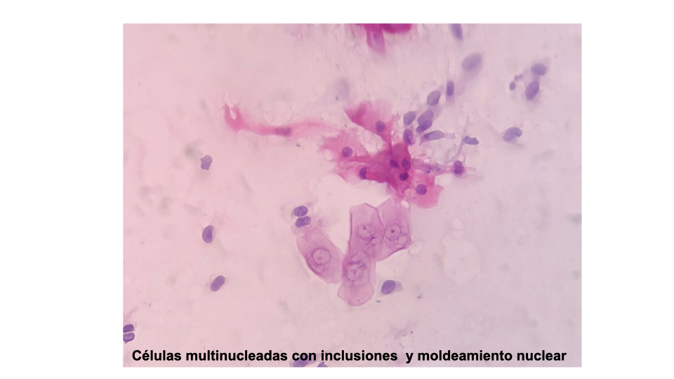Herpes simple ulcerado en pacientes VIH – PIEL-L Latinoamericana