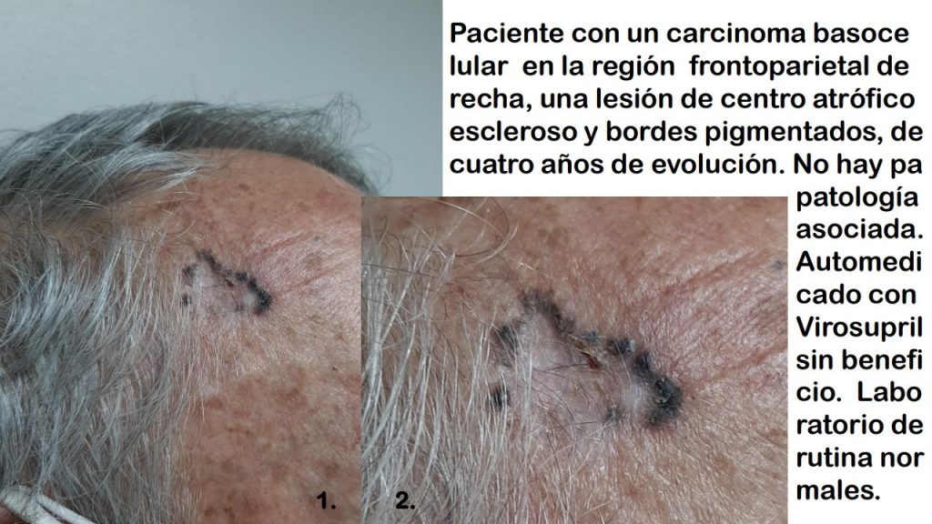 Carcinoma basocelular en la frente – PIEL-L Latinoamericana