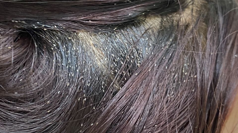 Pediculosis capitis – PIEL-L Latinoamericana