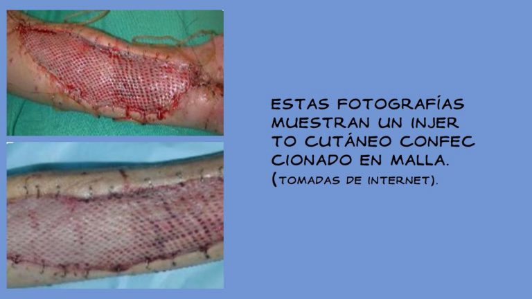 Injerto cutáneo – PIEL-L Latinoamericana