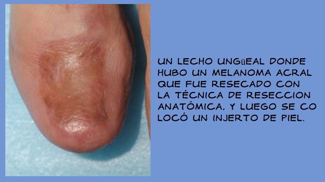 Injerto cutáneo – PIEL-L Latinoamericana