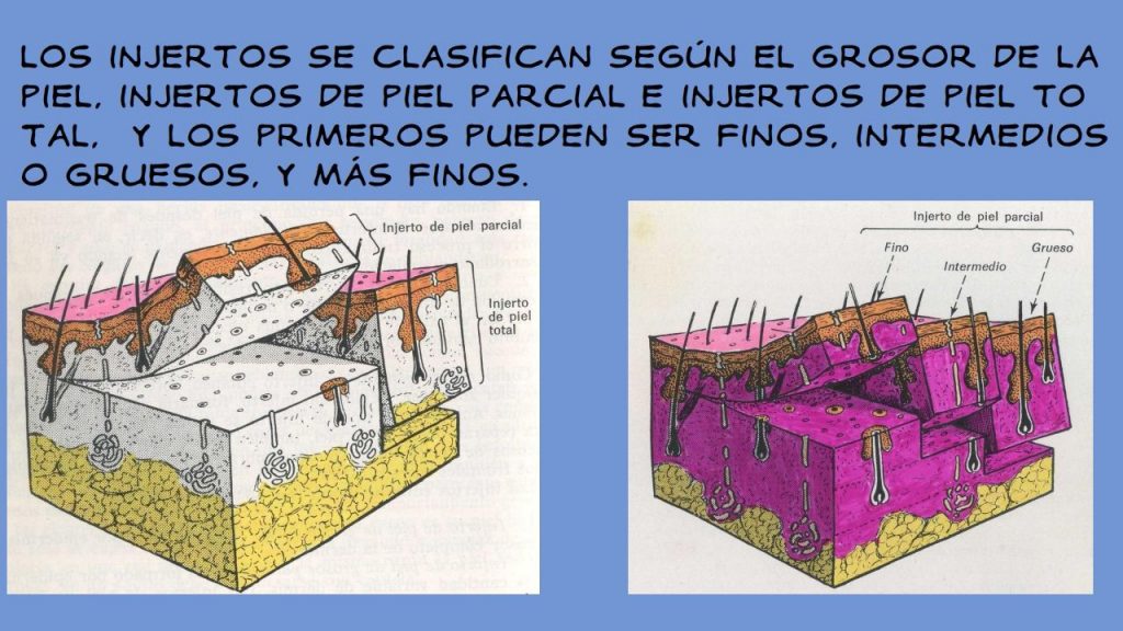 Injerto cutáneo – PIEL-L Latinoamericana