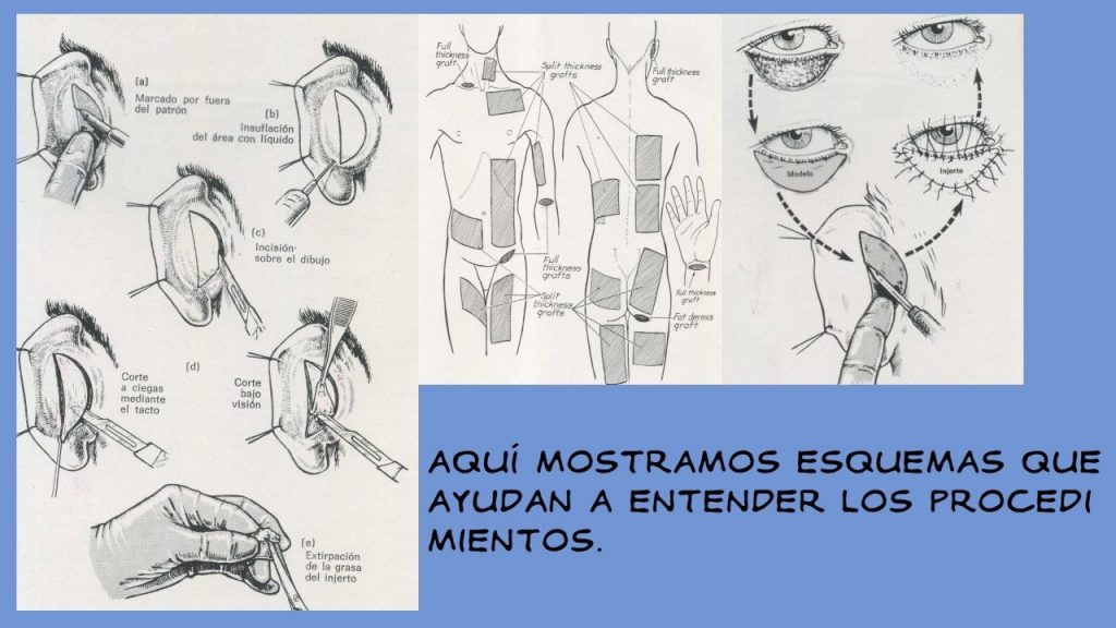 Injerto cutáneo – PIEL-L Latinoamericana