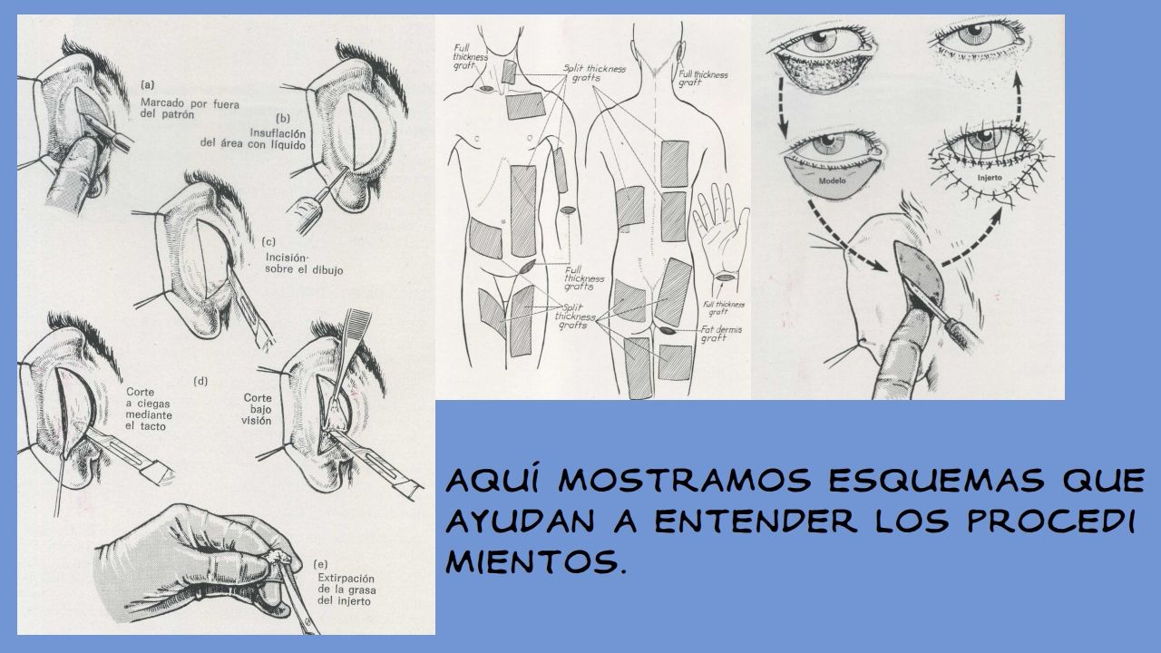 Injerto cutáneo – PIEL-L Latinoamericana
