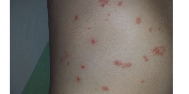Erupción placas – papulo eritematosa pruriginosa de larga evolución en ...