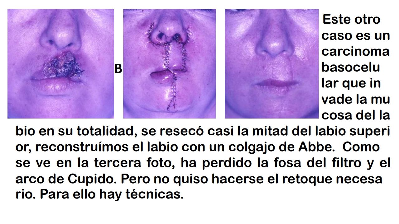 Neoplasias en los labios, resueltas con transferencias labiales – PIEL ...