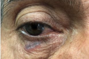 lesion-parpado-inferior – PIEL-L Latinoamericana