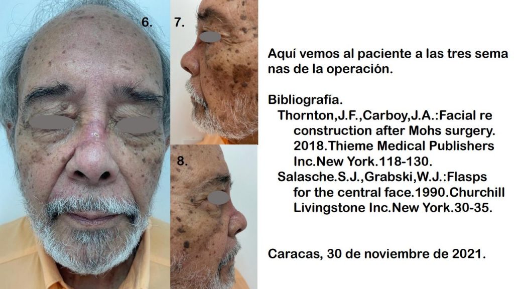 Carcinoma basocelular en el dorso nasal – PIEL-L Latinoamericana