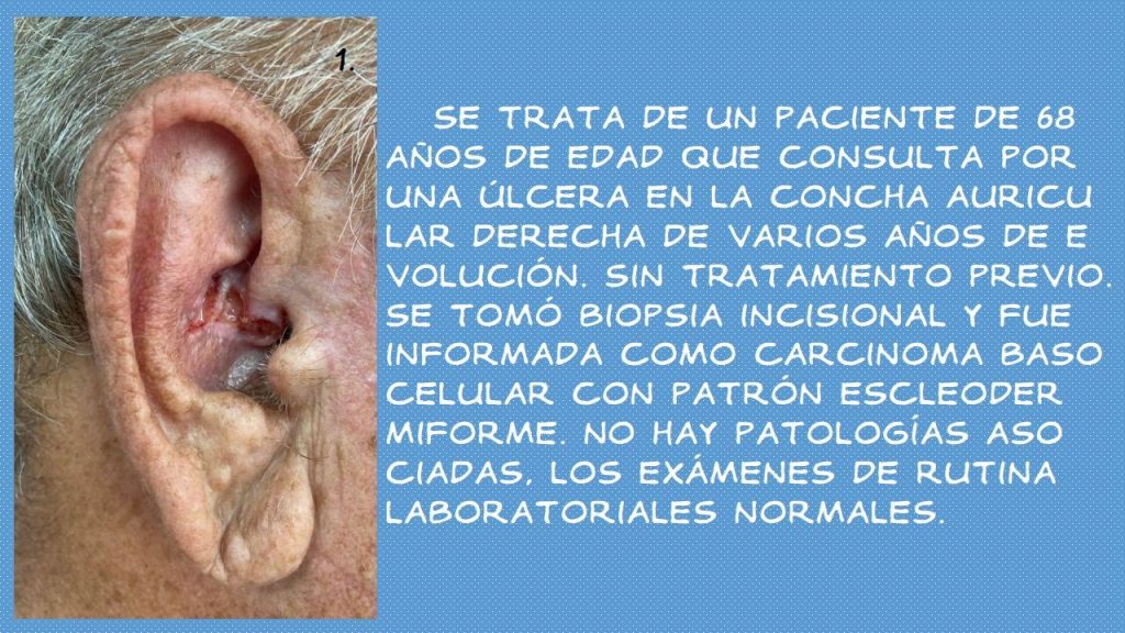 Carcinoma basocelular en la concha auricular. ¿Cómo lo reparamos ...
