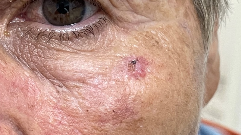 lesion-neoplasica – PIEL-L Latinoamericana