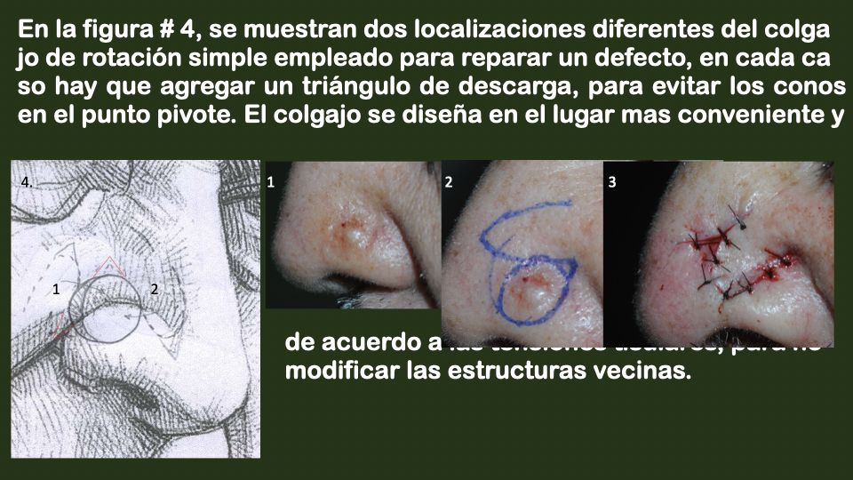 Reparación de la región perialar – PIEL-L Latinoamericana