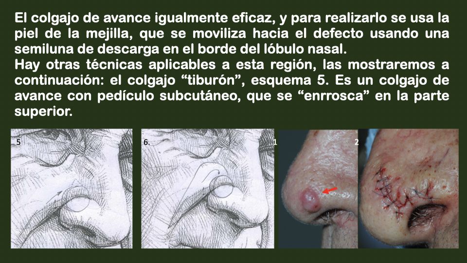 Reparación de la región perialar – PIEL-L Latinoamericana