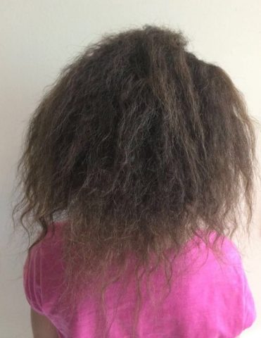 Síndrome de pelo impeinable – PIEL-L Latinoamericana