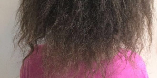 Síndrome de pelo impeinable – PIEL-L Latinoamericana