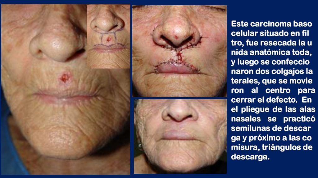 Abordaje quirúrgico de la piel del labio superior – PIEL-L Latinoamericana