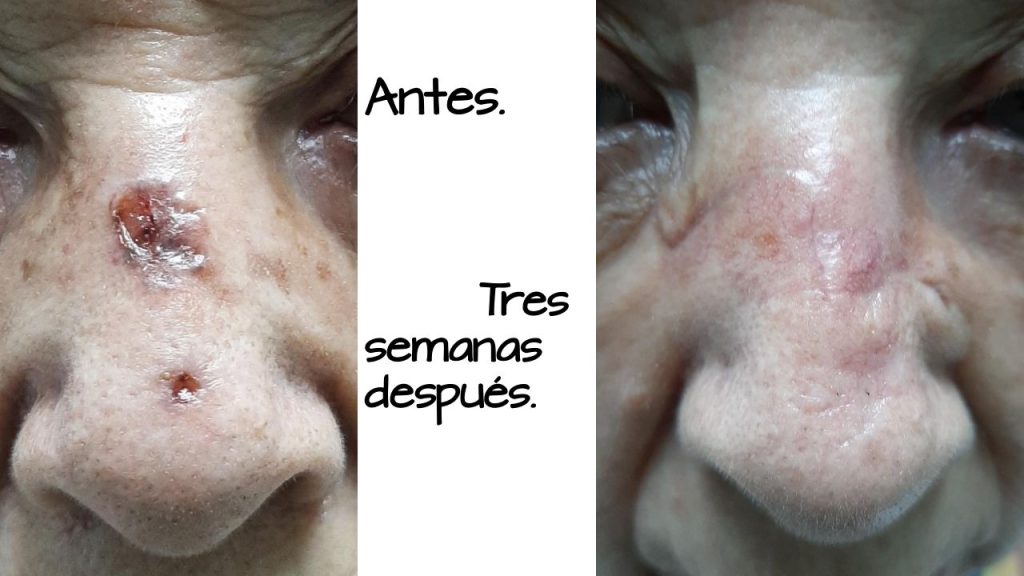 Dos carcinomas basocelulares en el dorso nasal – PIEL-L Latinoamericana