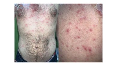 Herpes Zoster diseminado – PIEL-L Latinoamericana