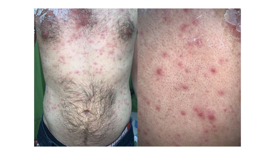 Herpes Zoster diseminado – PIEL-L Latinoamericana