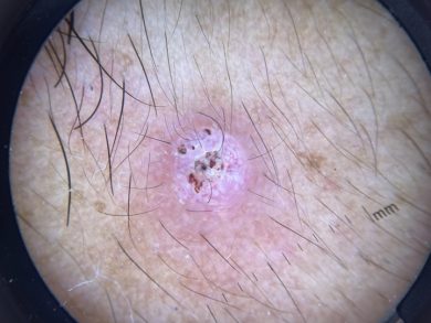 Lesion en la sien derecha.004 – PIEL-L Latinoamericana