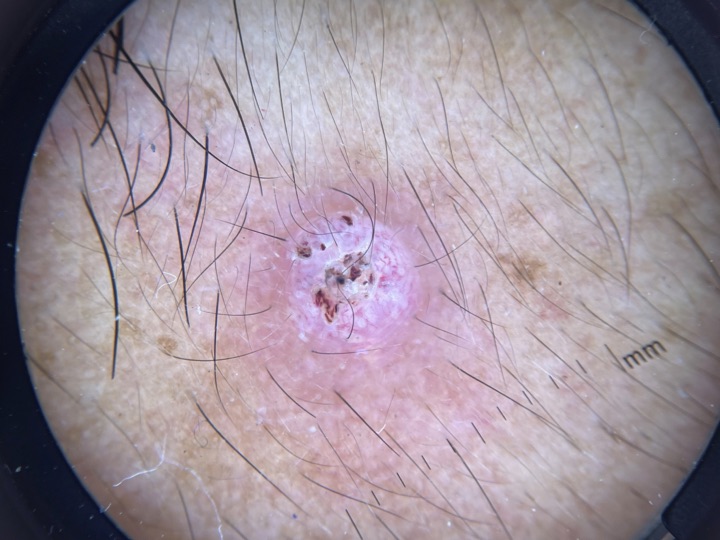 Lesión en la sien derecha – PIEL-L Latinoamericana