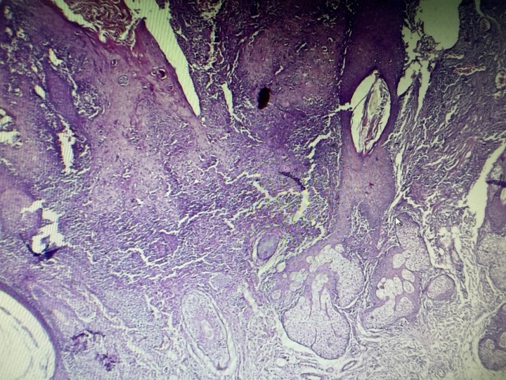 Lesion en la sien derecha.010 – PIEL-L Latinoamericana