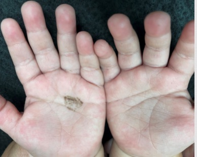 Mancha oscura en palma de mano – PIEL-L Latinoamericana