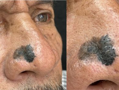 lesion-nariz.004 – PIEL-L Latinoamericana