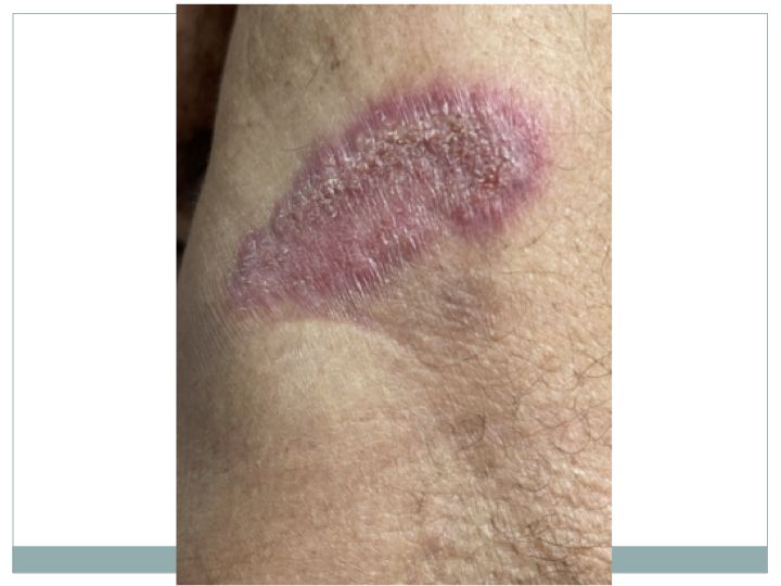 lesion-verrugosa.006 – PIEL-L Latinoamericana