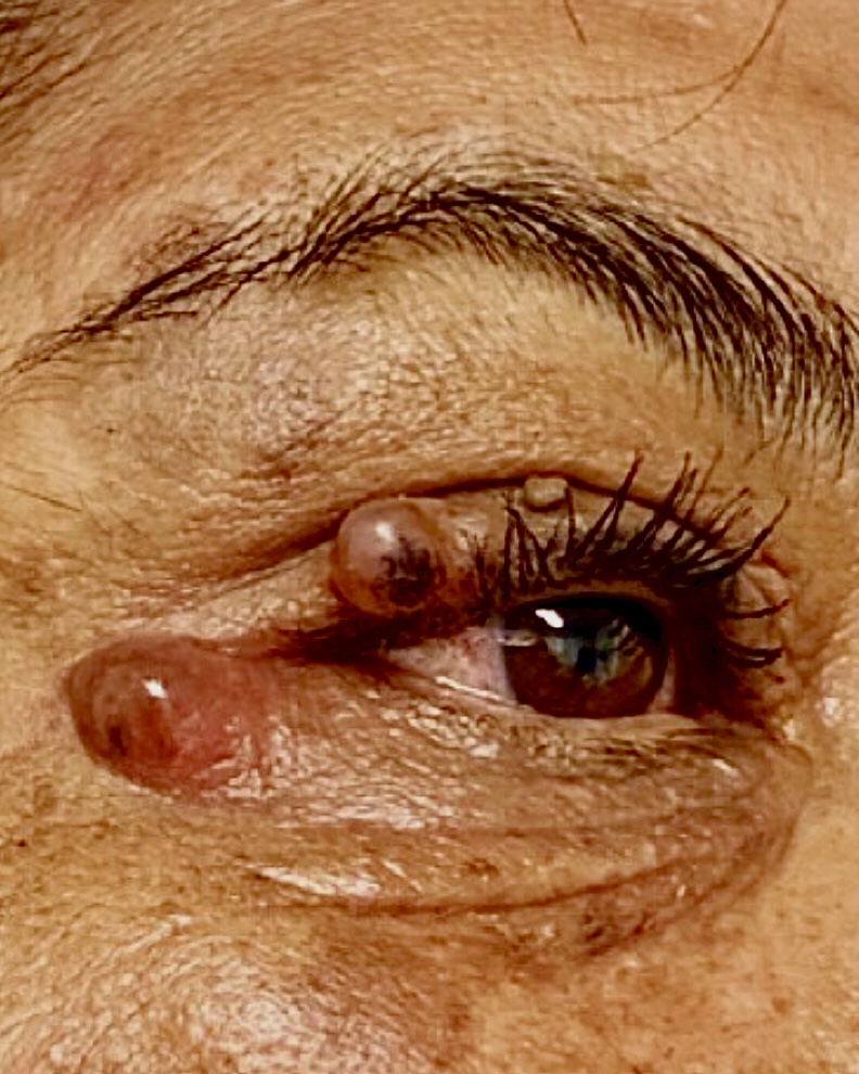 Hidrocistoma Apocrino Apocrine Hidrocystoma EyeWiki
