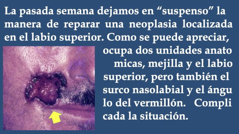 Carcinoma basocelular en el labio superior. Su reparación. Parte II ...