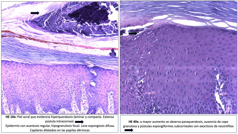 psoriasis pustulosa.004 – PIEL-L Latinoamericana