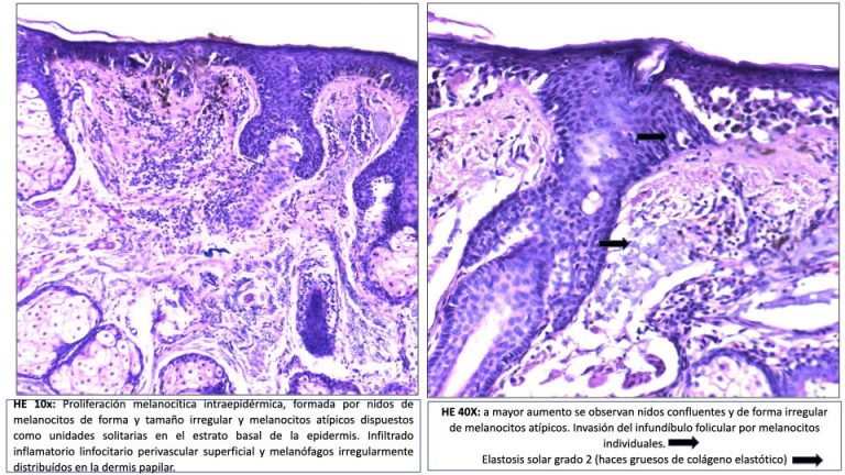 Melanoma maligno in situ.003 – PIEL-L Latinoamericana
