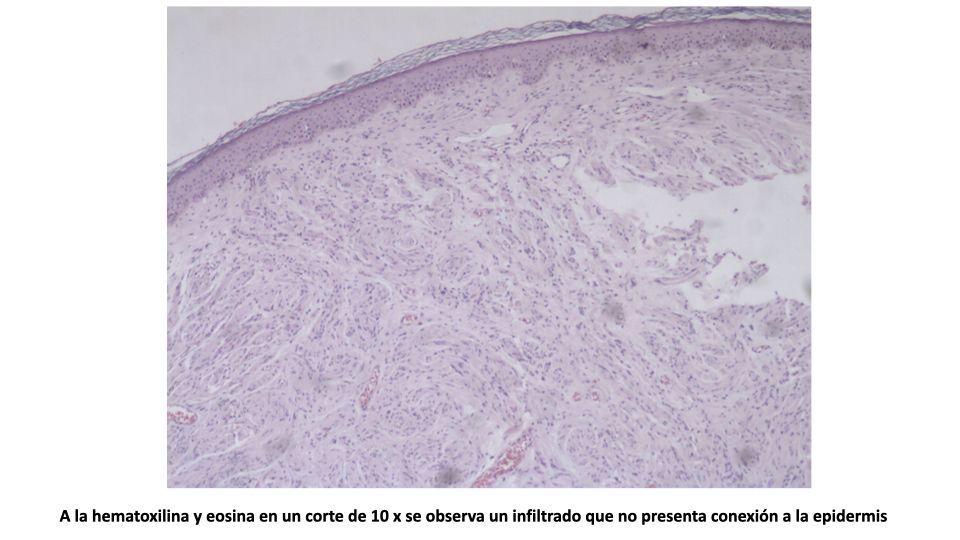 Leiomioma cutáneo – PIEL-L Latinoamericana