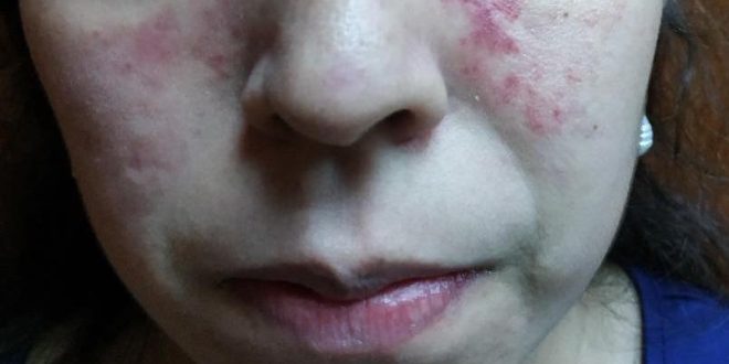 Lupus cutaneo rosaceaiforme + Angioma plano – PIEL-L Latinoamericana