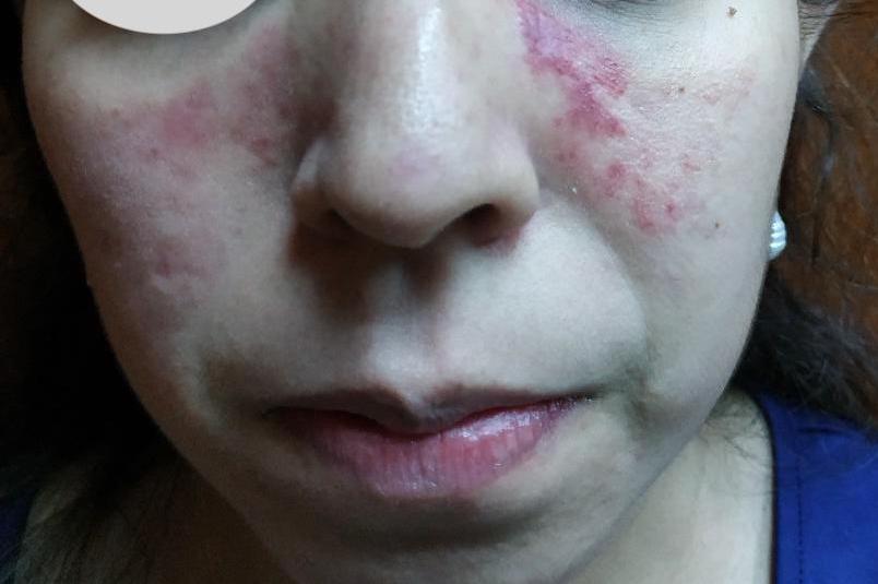 Lupus cutaneo rosaceaiforme + Angioma plano – PIEL-L Latinoamericana