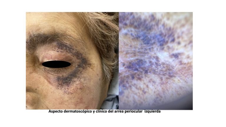 Ocronosis exógena – PIEL-L Latinoamericana