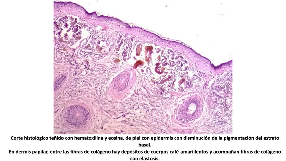 Ocronosis exógena – PIEL-L Latinoamericana