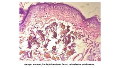 ocronosis exogena.009_09 – PIEL-L Latinoamericana