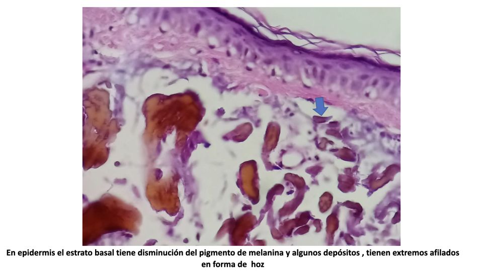 Ocronosis exógena – PIEL-L Latinoamericana
