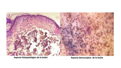 ocronosis exogena.011_11 – PIEL-L Latinoamericana