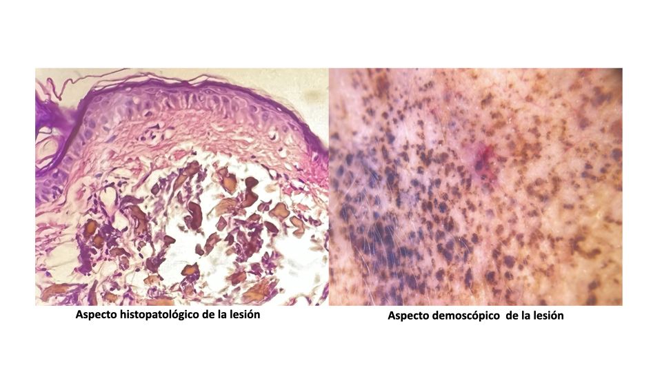 ocronosis exogena.011_11 – PIEL-L Latinoamericana