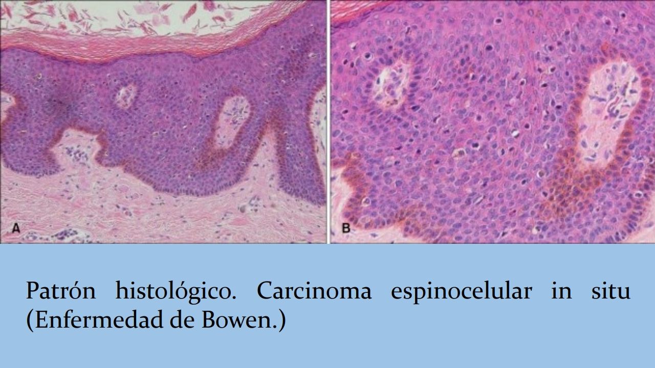 Enfermedad de Bowen digital – PIEL-L Latinoamericana