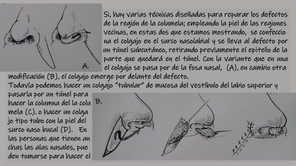 Un carcinoma basocelular en la columela. De qué manera se reparó ...