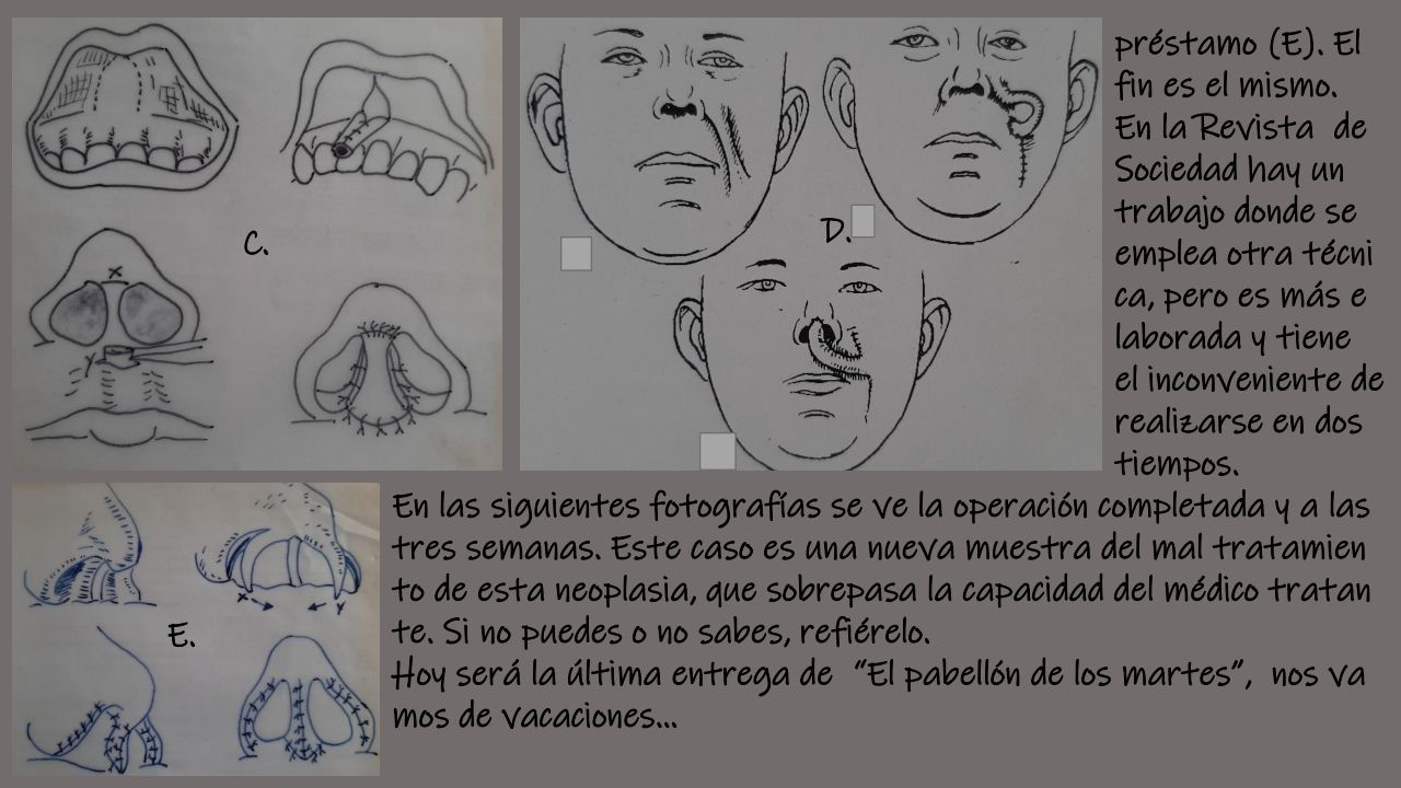 Un carcinoma basocelular en la columela. De qué manera se reparó ...