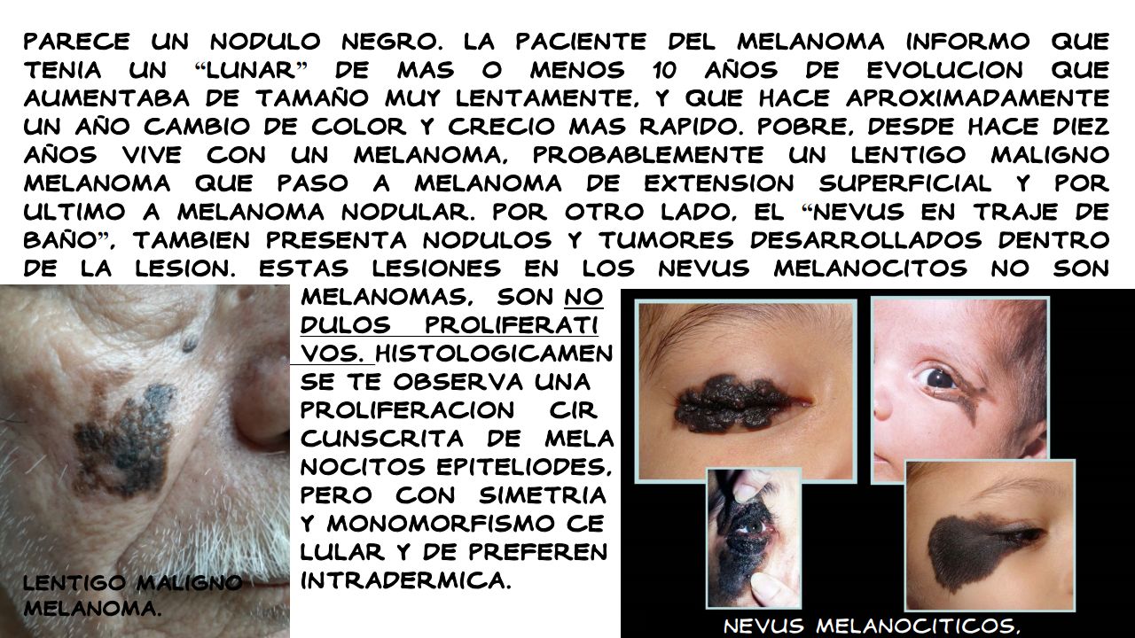 NEVUS. Melanocíticos y Melanoma – PIEL-L Latinoamericana