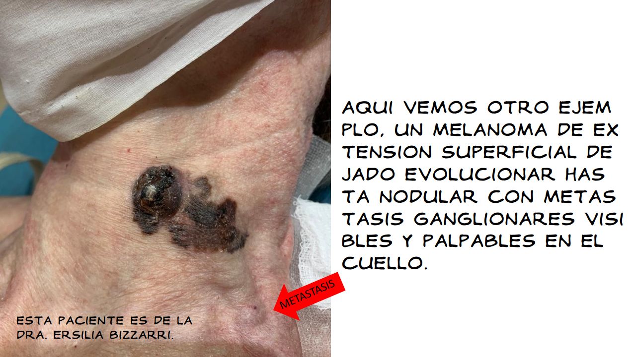 NEVUS. Melanocíticos y Melanoma – PIEL-L Latinoamericana