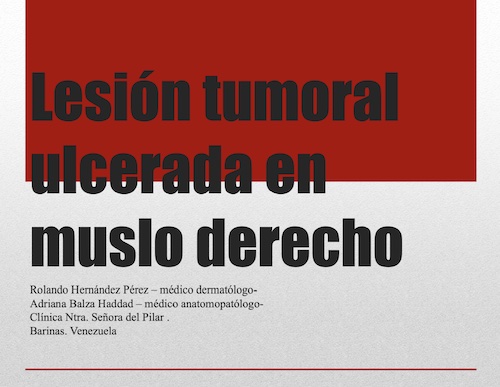 Lesión tumoral ulcerada en muslo derecho – PIEL-L Latinoamericana