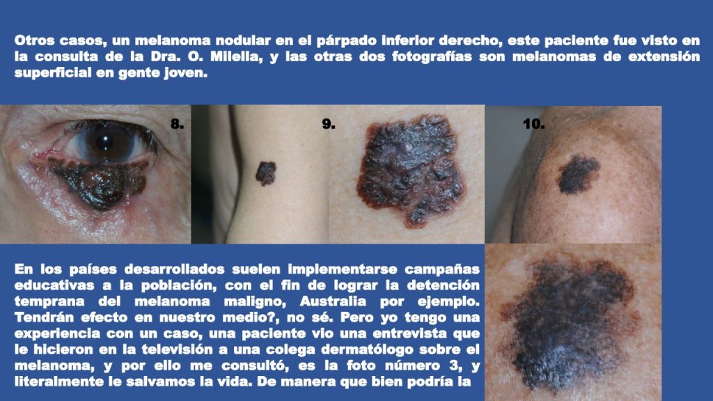 Seguimos con el melanoma maligno – PIEL-L Latinoamericana