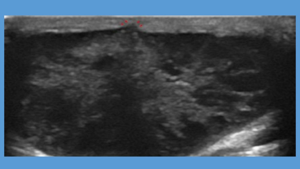 Quiste de inclusión Epidérmico – PIEL-L Latinoamericana